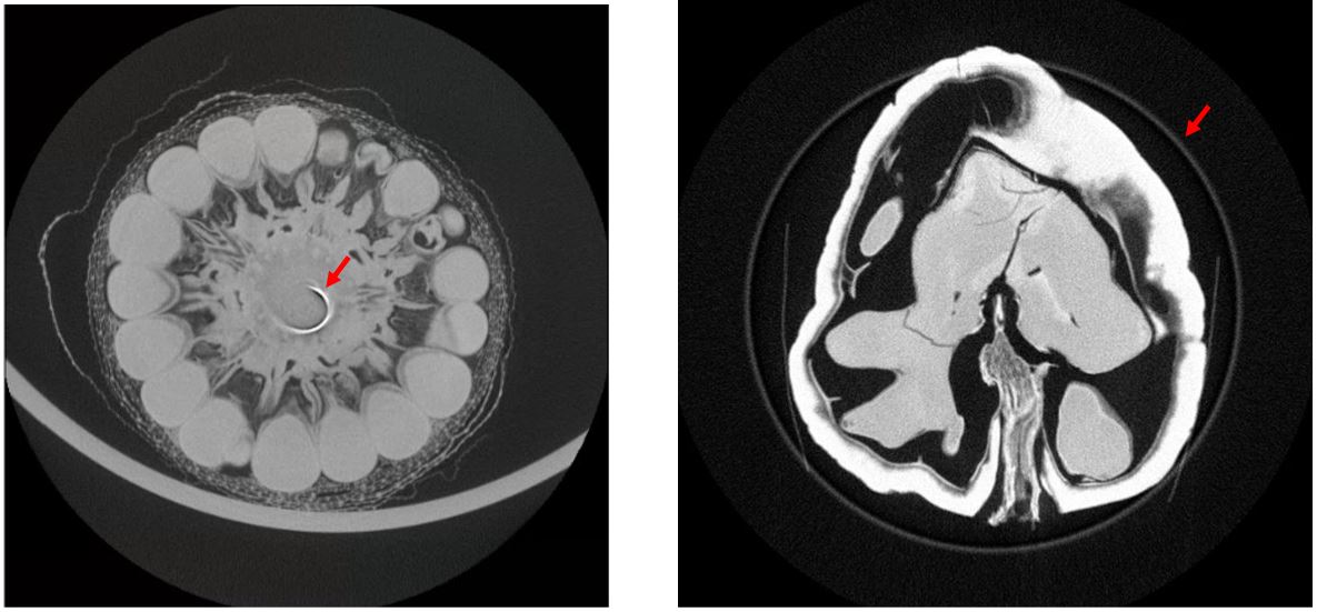 How to Recognize CT Artifacts and Minimize Them During Data Collection